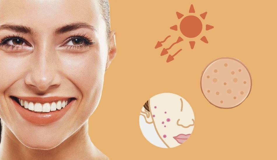 5 Summer Skin Woes And How To Deal With Them